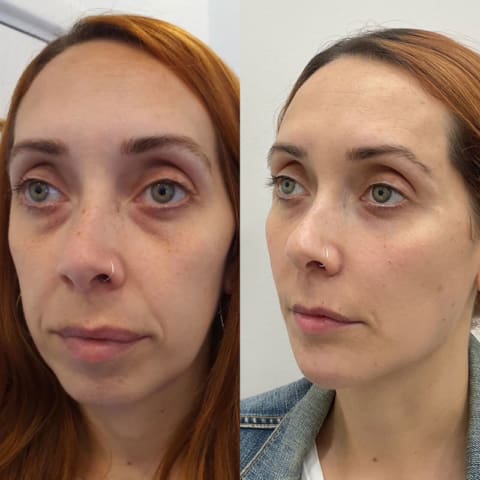 Cheek Fillers Westminster | Midface | Takroni Clinic