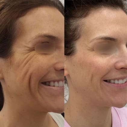 Cheek Fillers Westminster | Midface | Takroni Clinic