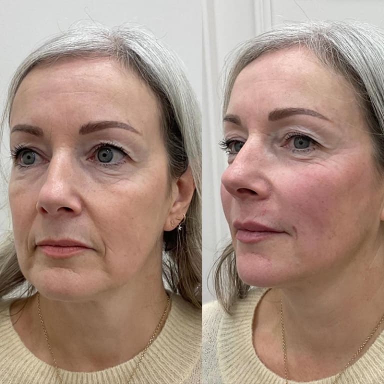 Full Face Transformation London | Takroni Clinic Facial Aesthetics