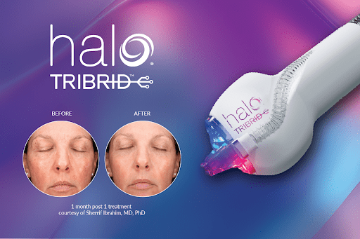 HALO Tribrid™ Laser Resurfacing | First Clinic in London Offering ...
